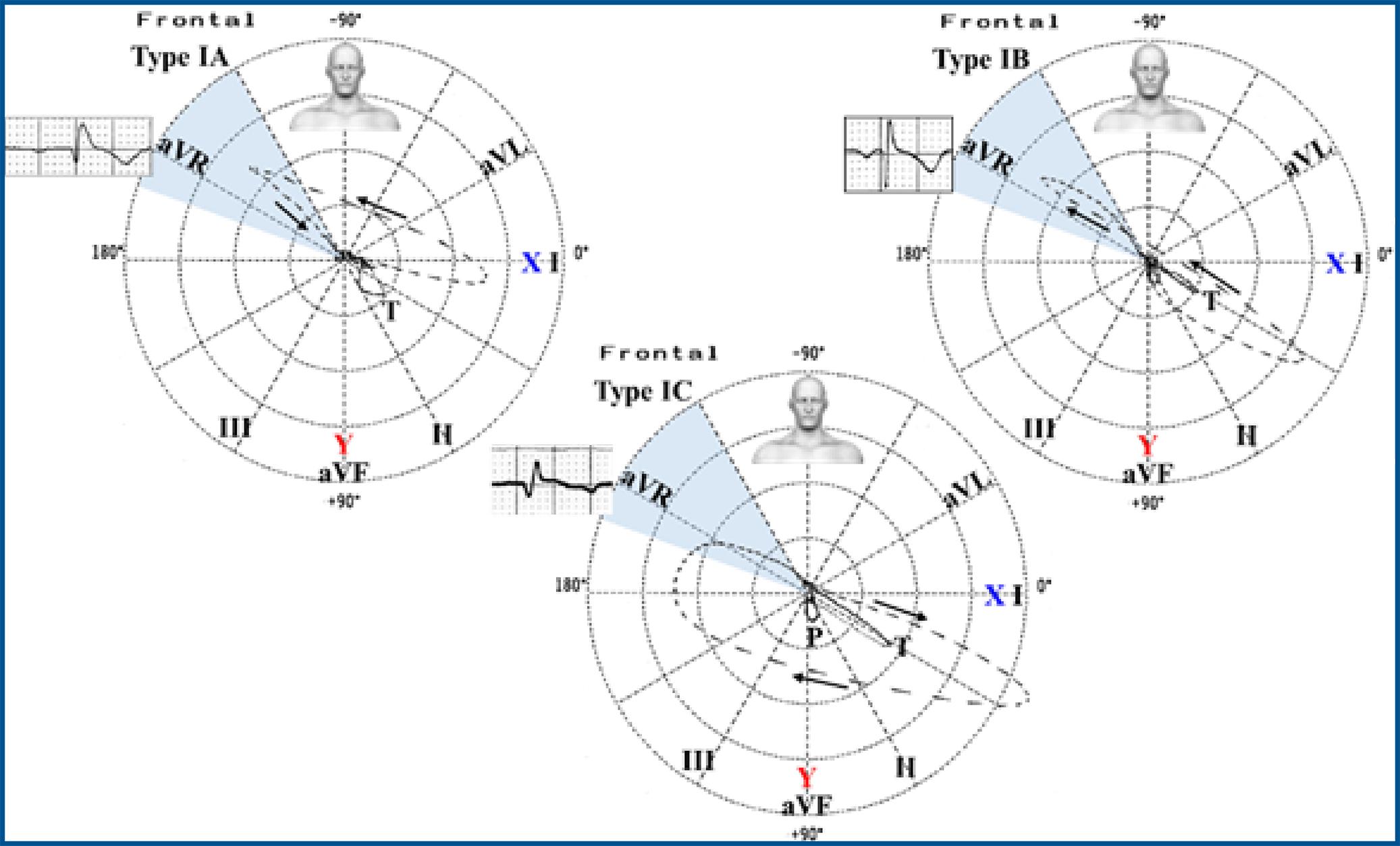 Vectocardiographic analysis of right ventricular electrical conduction ...