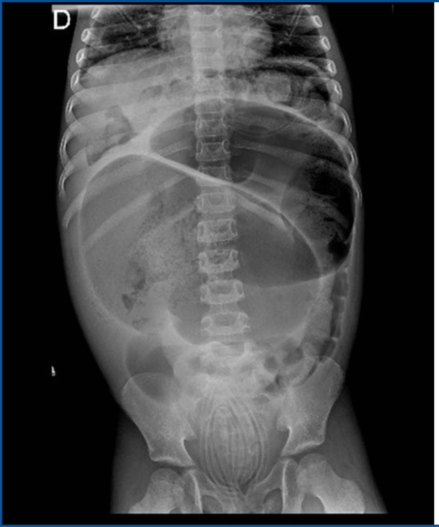Sigmoid volvulus as a complication of imperforate anus: a case report