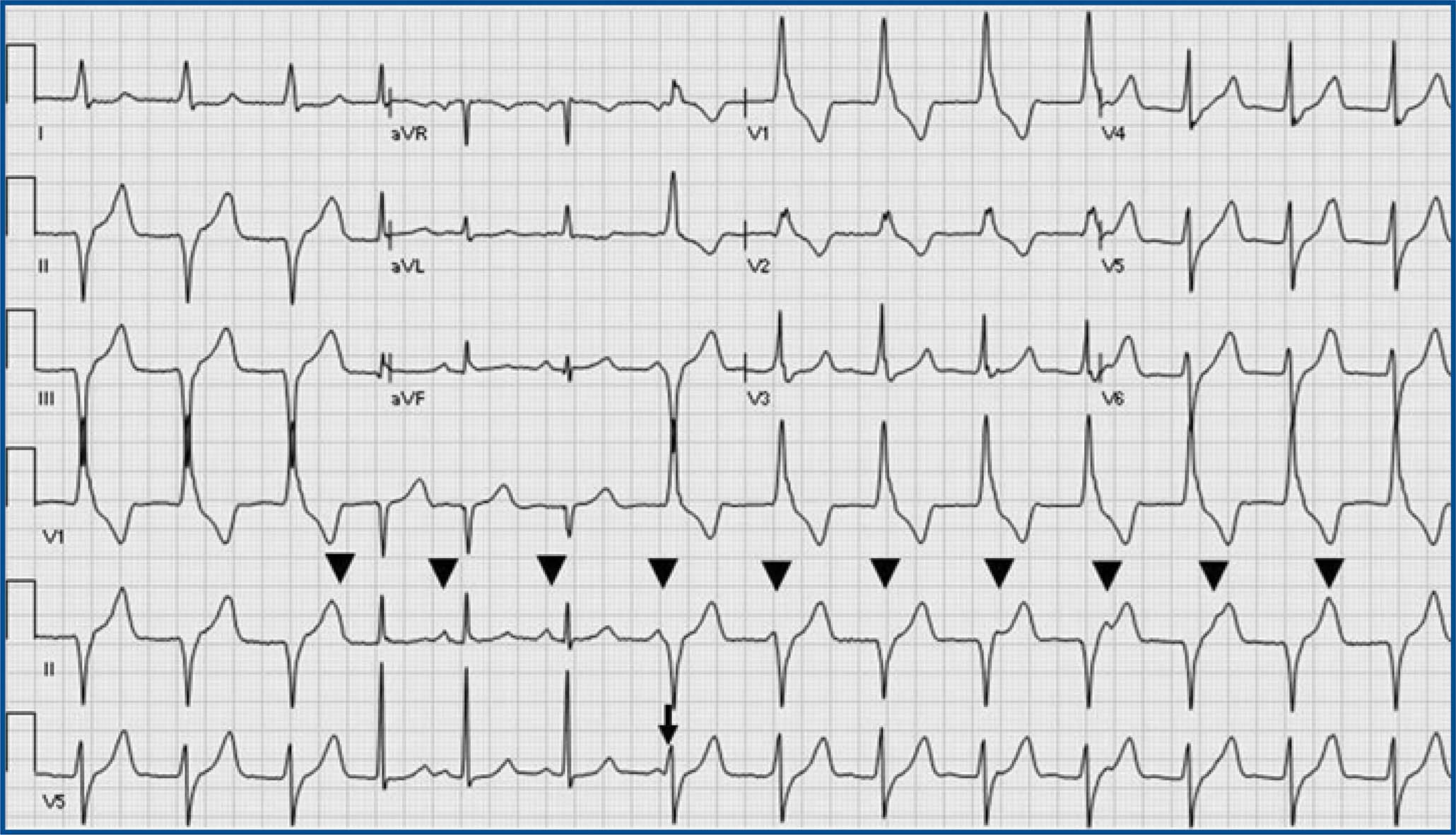 Accelerated idioventricular rhythm in the adult: an update