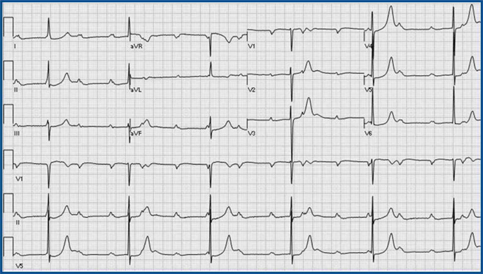 Accelerated idioventricular rhythm in the adult: an update