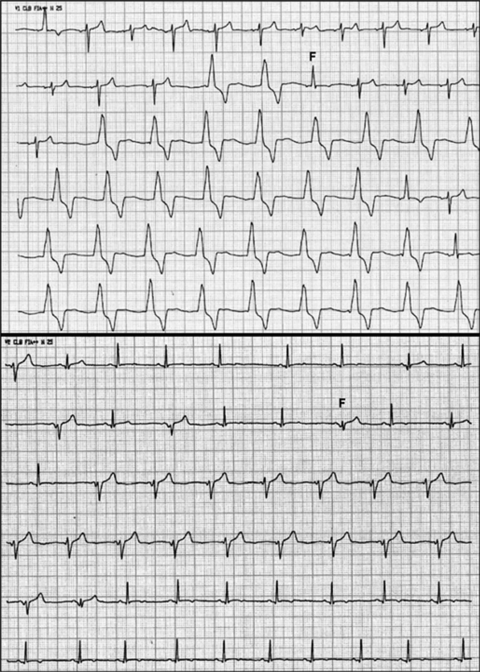 Accelerated idioventricular rhythm in the adult: an update