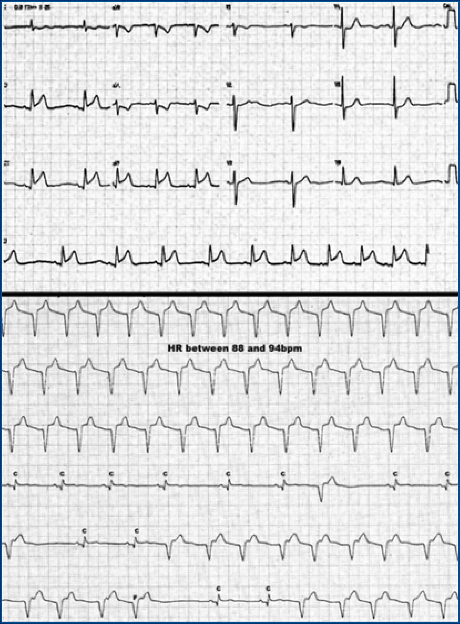 Accelerated idioventricular rhythm in the adult: an update